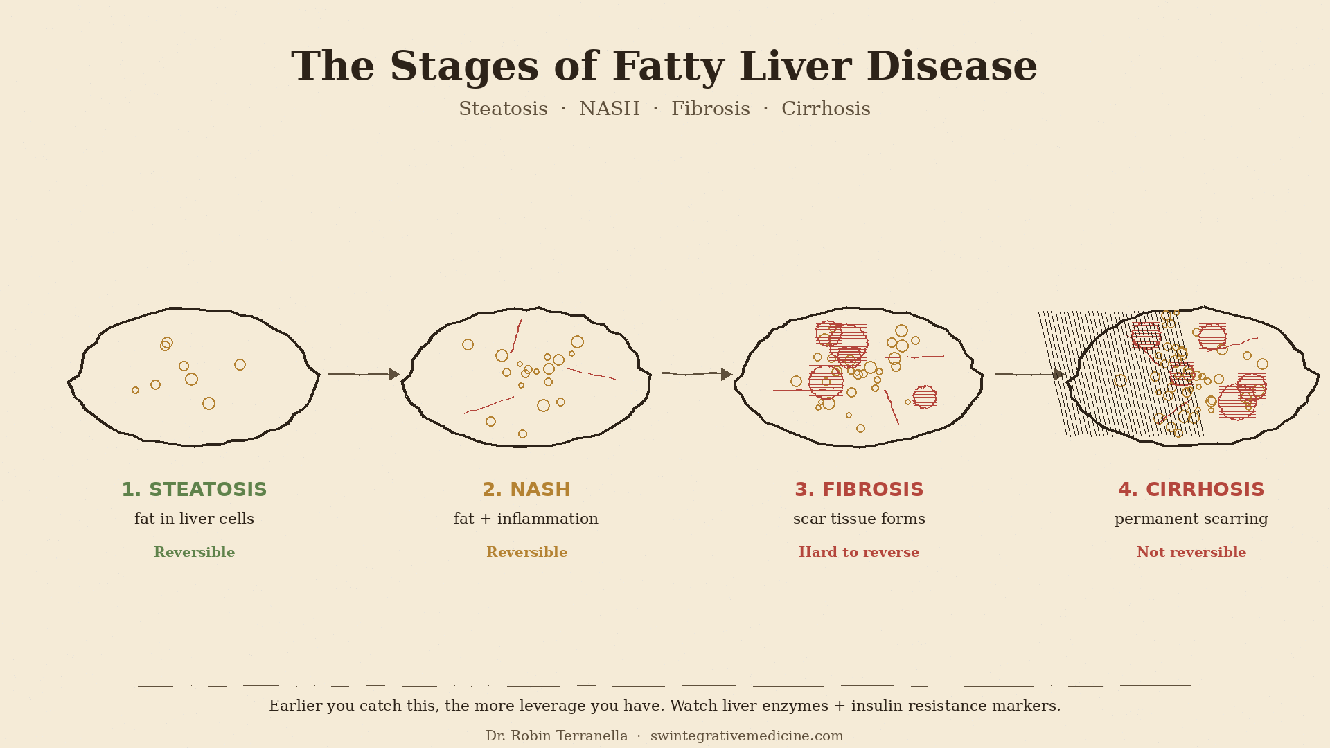 These Are The Stages Of Fatty Liver Disease